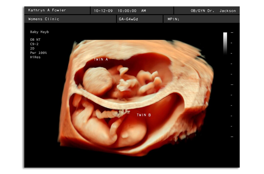 Prank With Friend Fake Ultrasound Picture Echography Scans First Baby ...