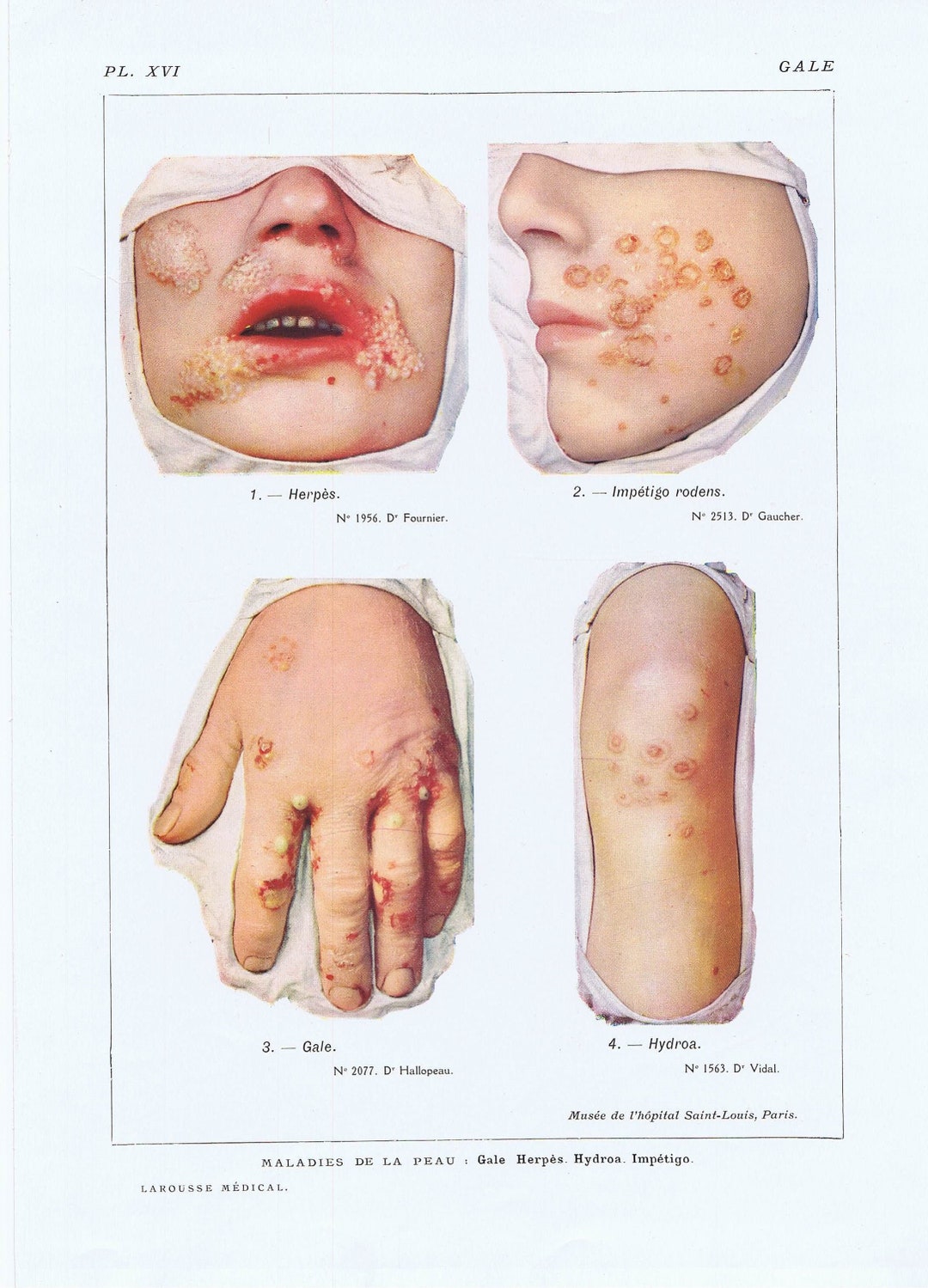 1925, Huidziekte, Herpes, Huid, Lichaam, Antieke Anatomie Prent ...