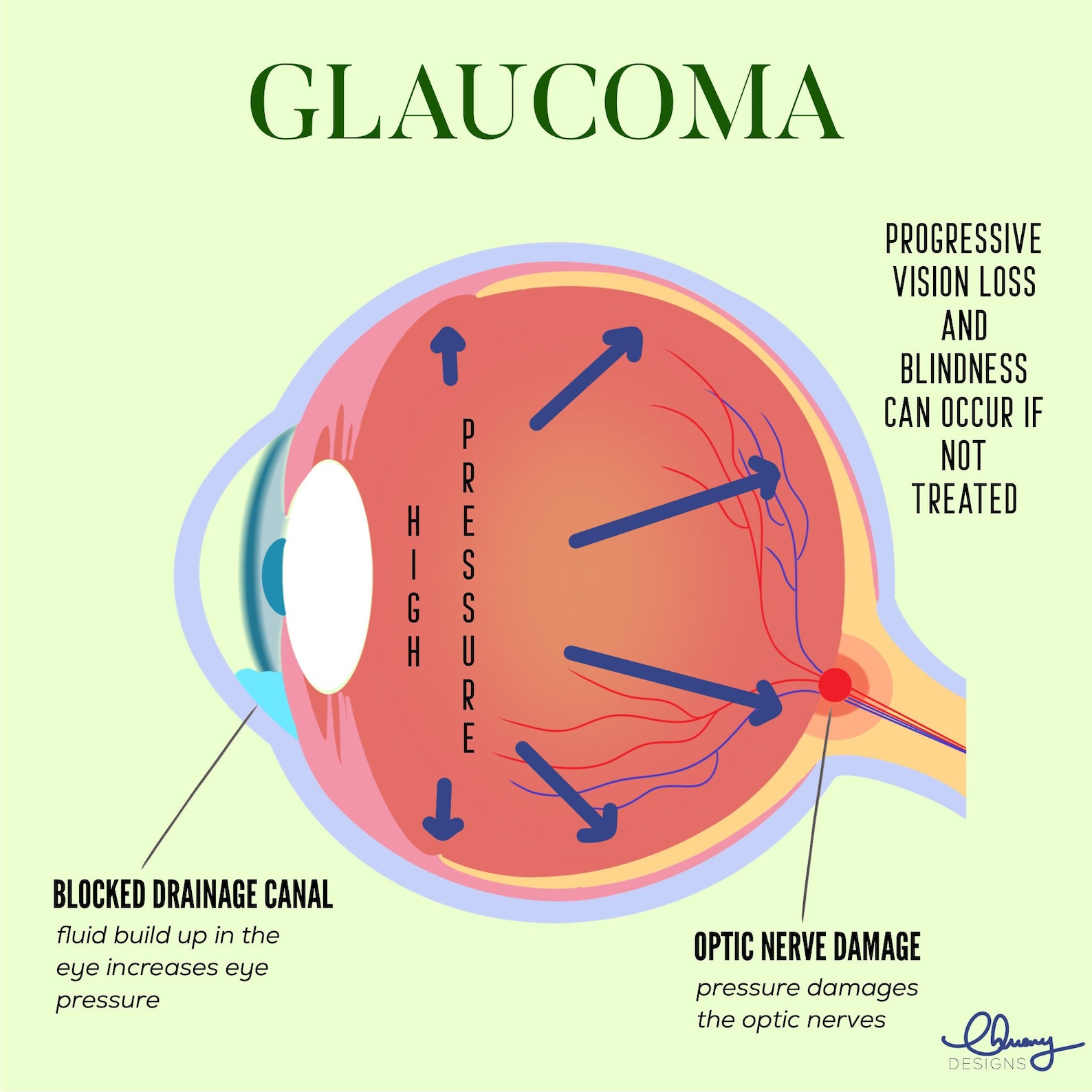 Digital Download - Glaucoma Infographic Poster | Optometry ...