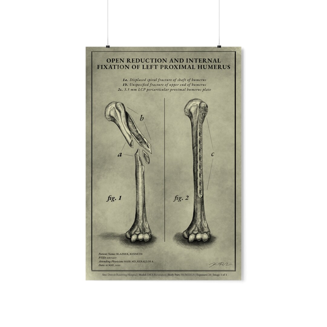 Unframed Print - “open Reduction and Internal Fixation of Left Proximal ...