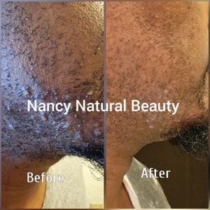 Razor Bump Stopper Cream: Natural Skin Treatment - Etsy