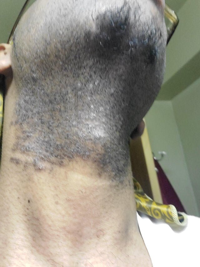 Natural Razor Bumps & Ingrown Hair |dark Beard Marks Remover - Etsy