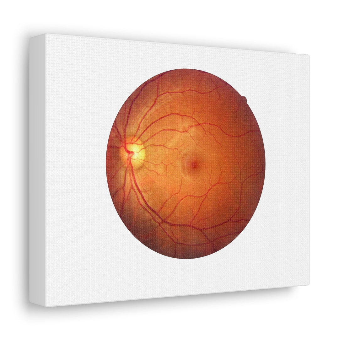 Human Eye Optic Disc Canvas Gallery Wraps - Etsy
