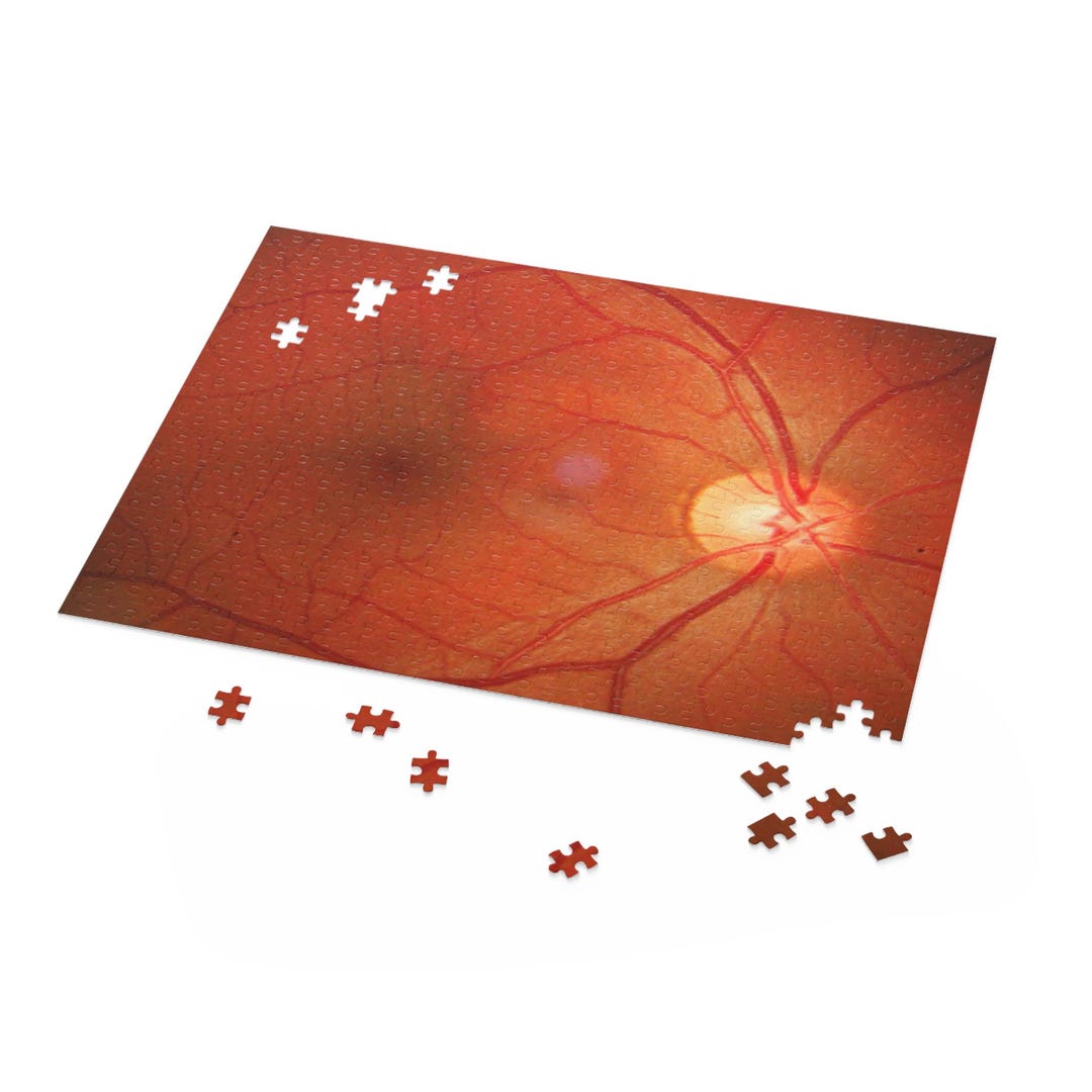 Puzzle, Retina Photo Fundus Photography Macula Optic Nerve Eye Doctor ...