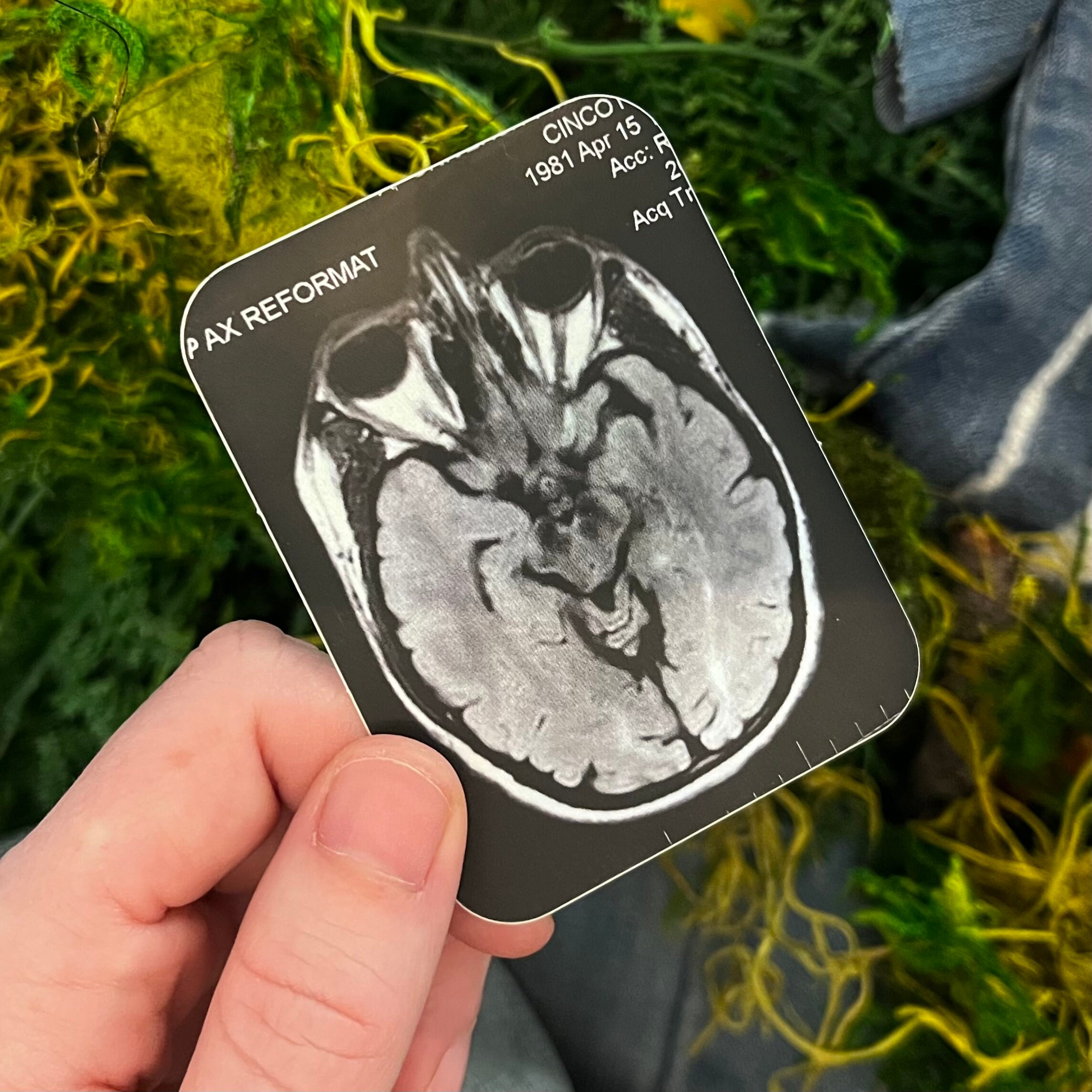 MRI Brain Scan Multiple Sclerosis Handmade STICKER - Etsy