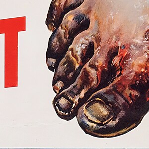 1943 "this is Trench Foot - Prevent It!" - WW2 Era Health Poster - Etsy