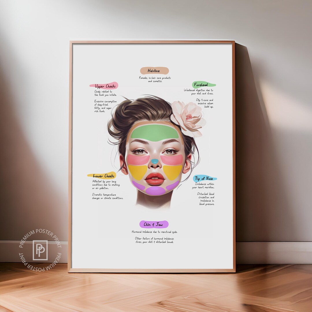 Acne Diagram, Acne Face Map, Esthetician Decor, Dermatologist Art ...
