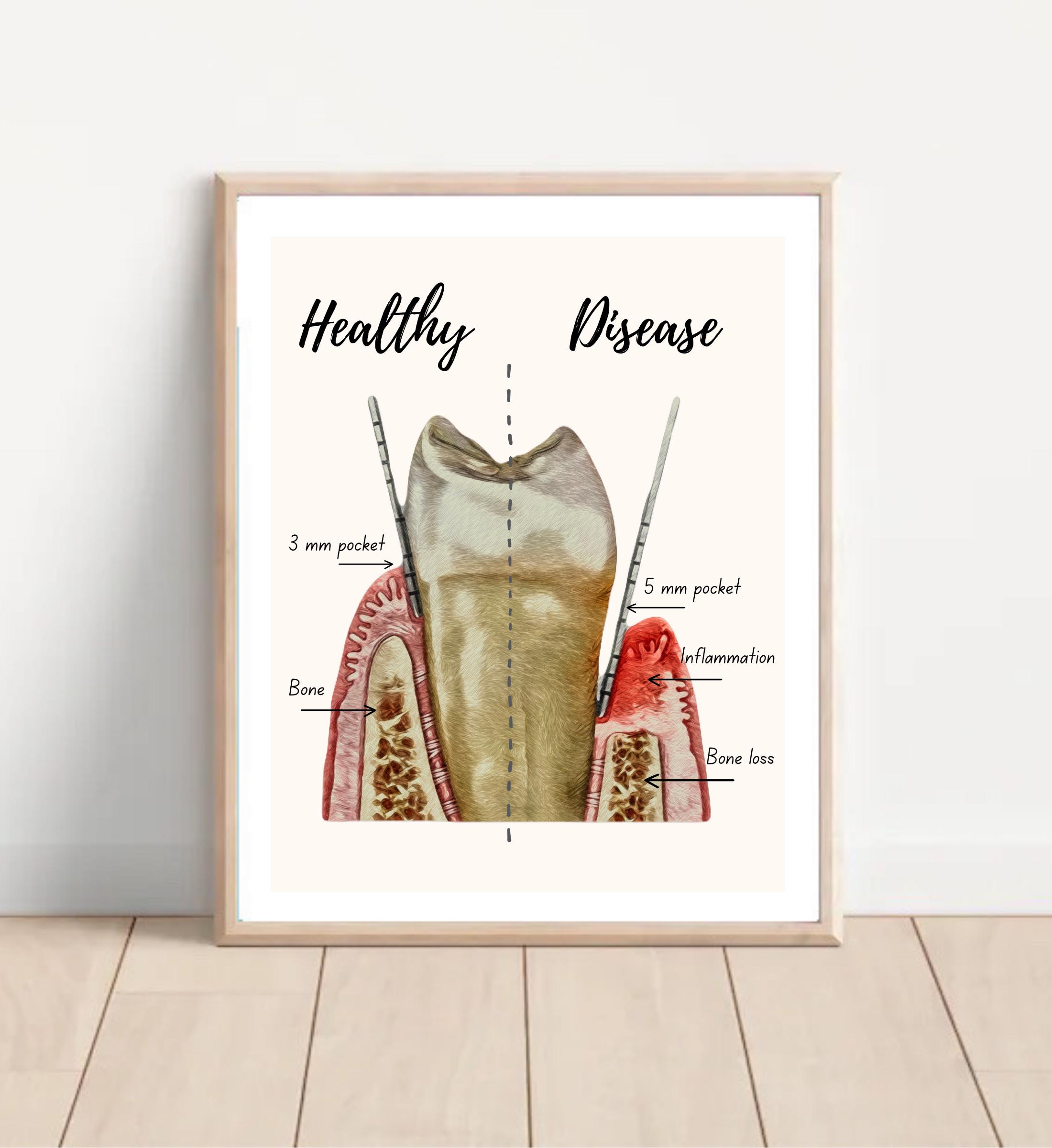 Gum Disease Anatomy Poster: Dental Office Art - Etsy UK