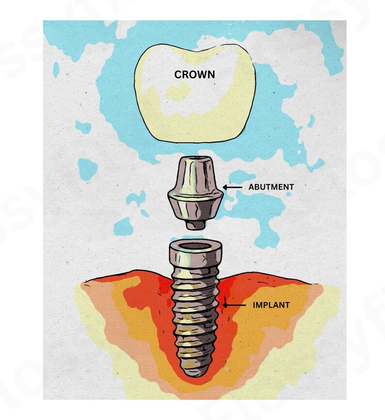 Watercolor Dental Implant Anatomy Poster, Labeled Tooth Art - Etsy
