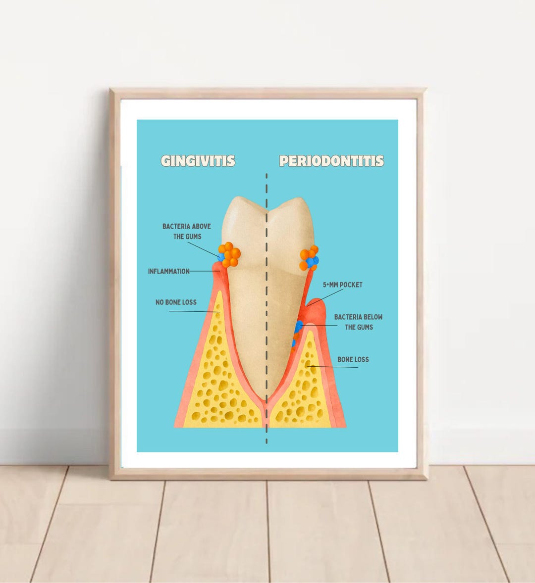 Gingivitis Vs Periodontal Disease Poster - Dental Health Infographic ...