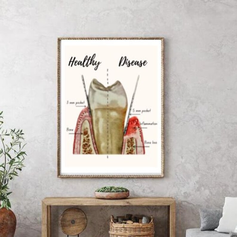 Gum Disease Anatomy Poster: Dental Office Art - Etsy