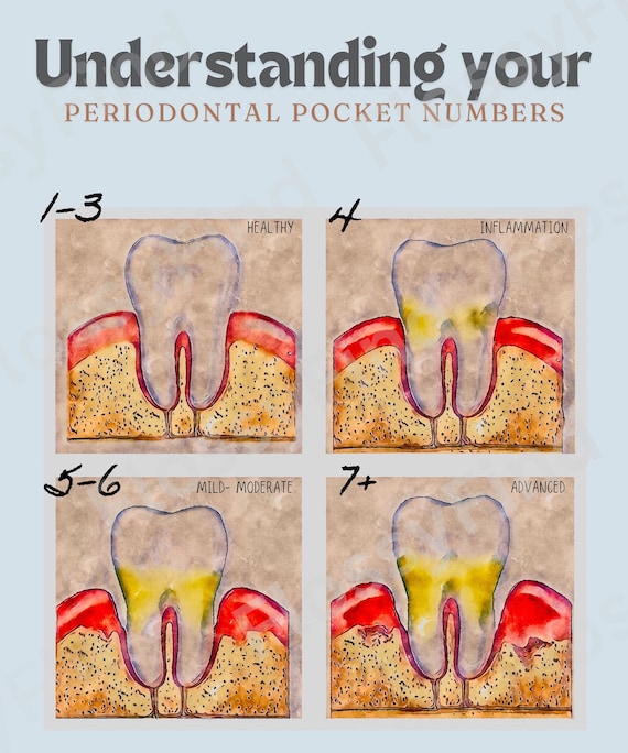 Estagios Da Doenca Periodontal