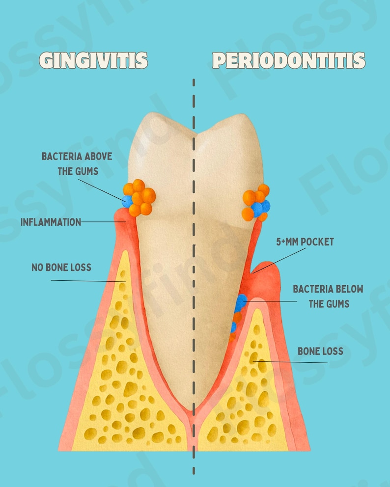 Gingivitis Vs Periodontal Disease Poster - Dental Health Infographic ...