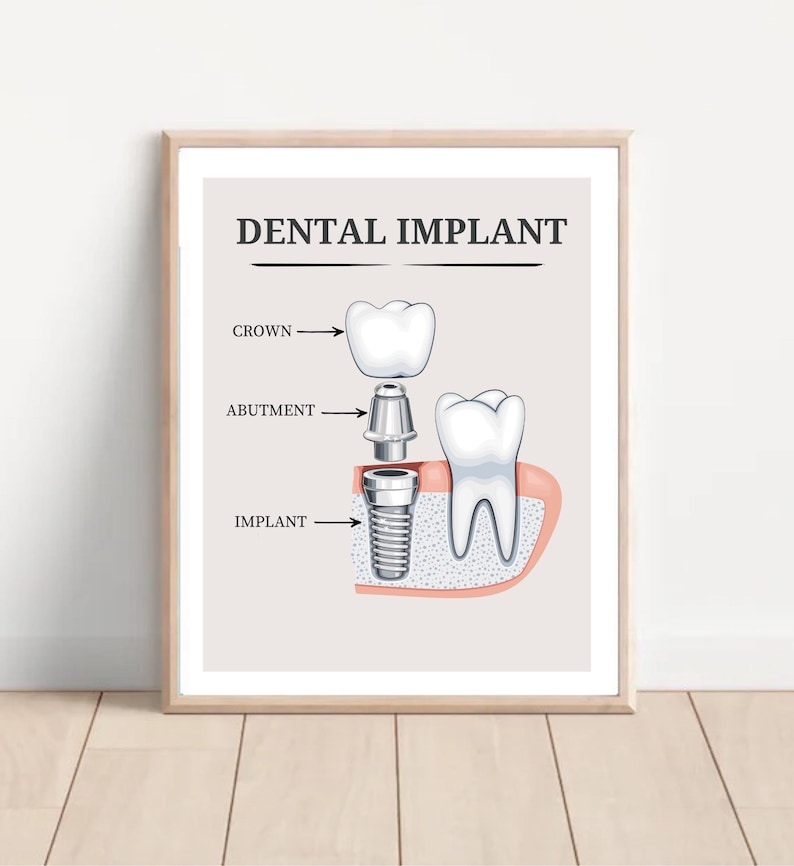 Dental Implant Anatomy Poster: Dentist Office Decor - Etsy