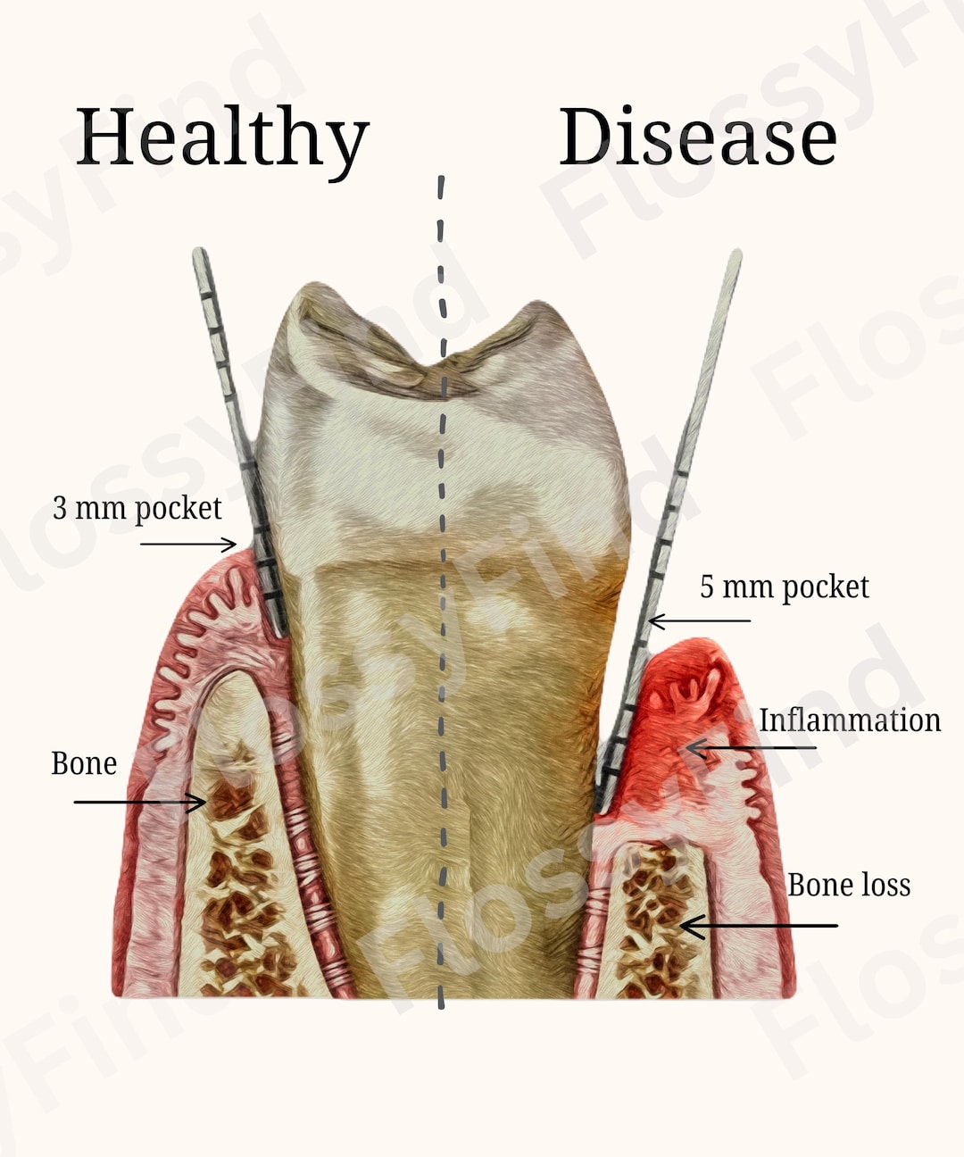 Tooth Chart: Periodontal Disease Patient Education (digital Download ...