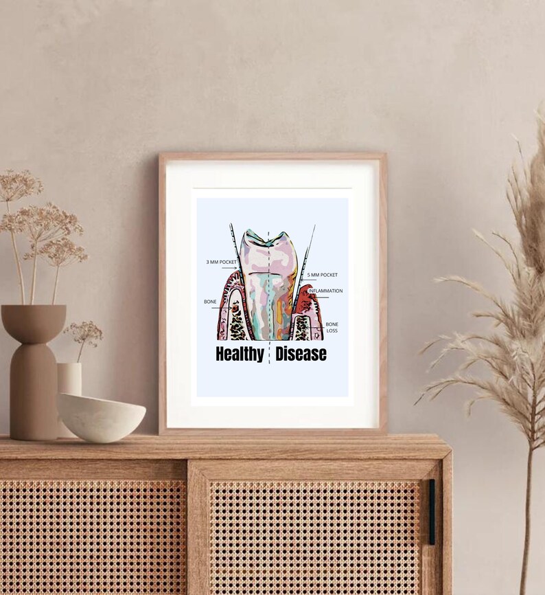 Periodontal Disease Anatomy Poster - Patient Education for Dentists - Etsy