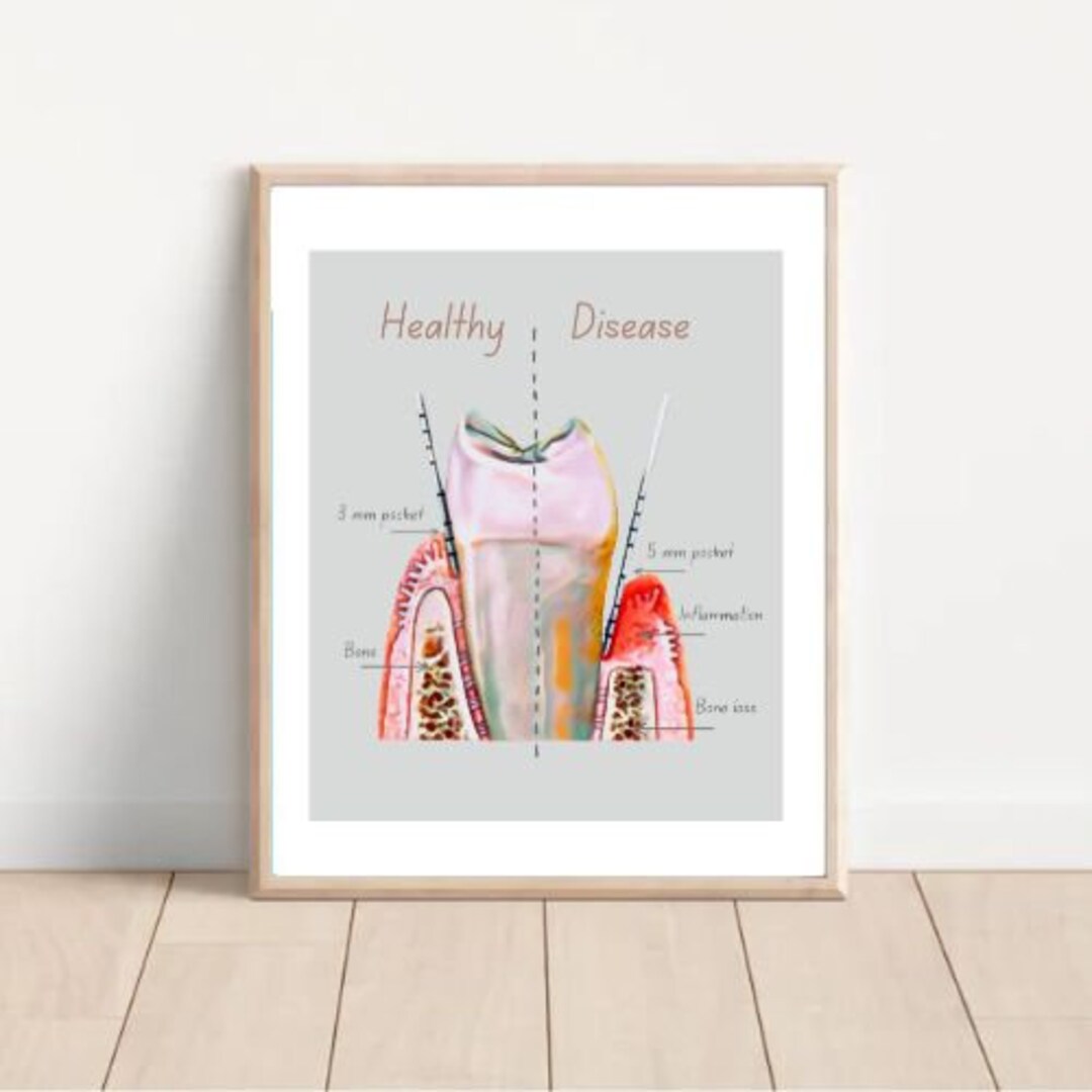 Tooth Anatomy Poster, Periodontal Disease Education, Gum Disease Wall ...