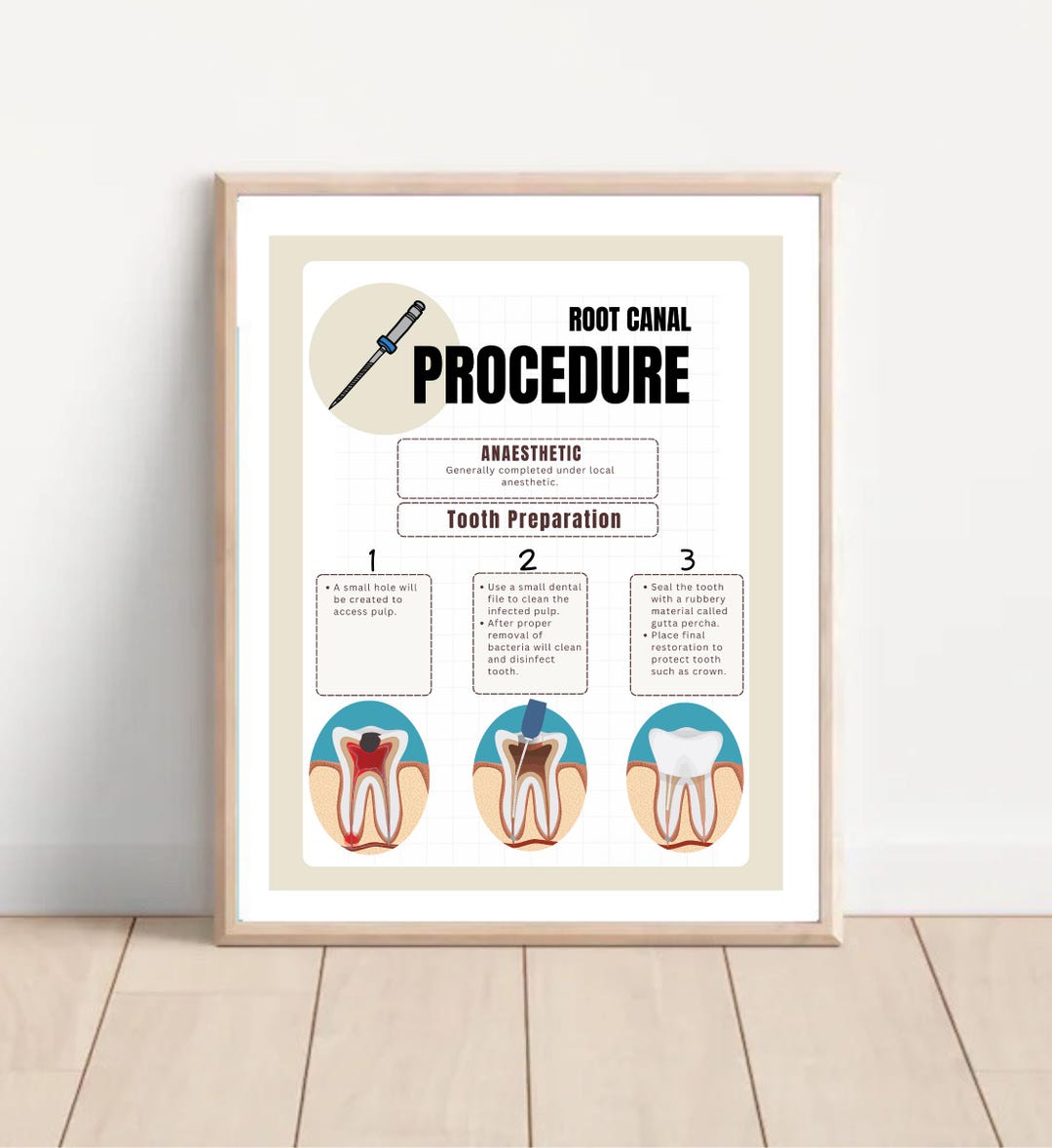 Root Canal Procedure Poster, Patient Education for Endodontist, Dental ...