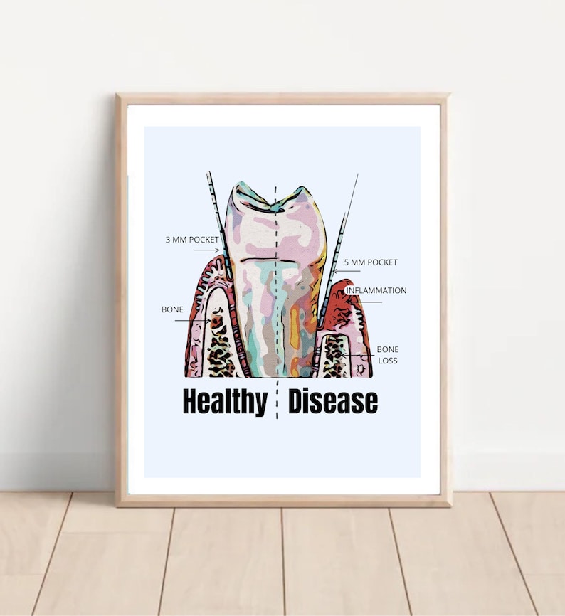 Periodontal Disease Anatomy Poster - Patient Education for Dentists - Etsy