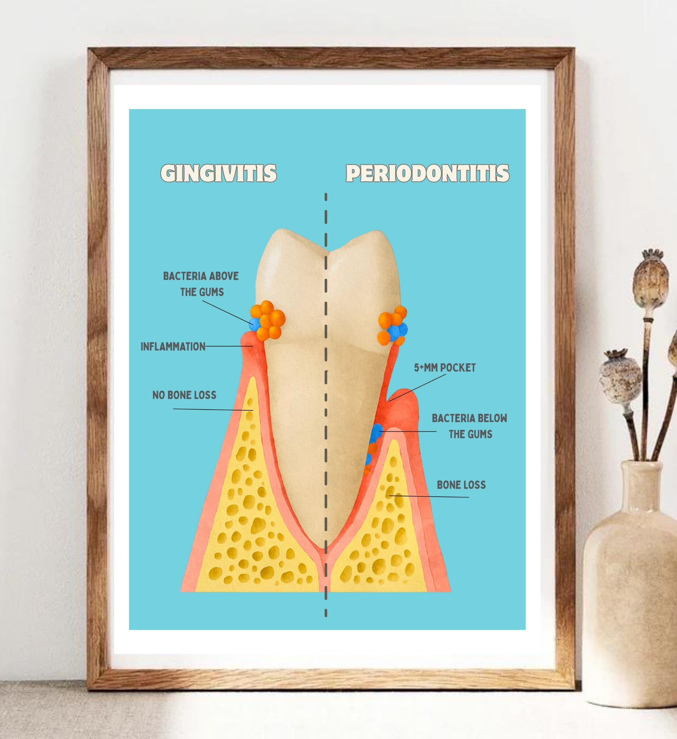 Gingivitis Vs Periodontal Disease Poster - Dental Health Infographic ...