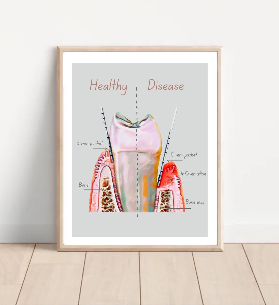 Tooth Anatomy Poster, Periodontal Disease Education, Gum Disease Wall ...