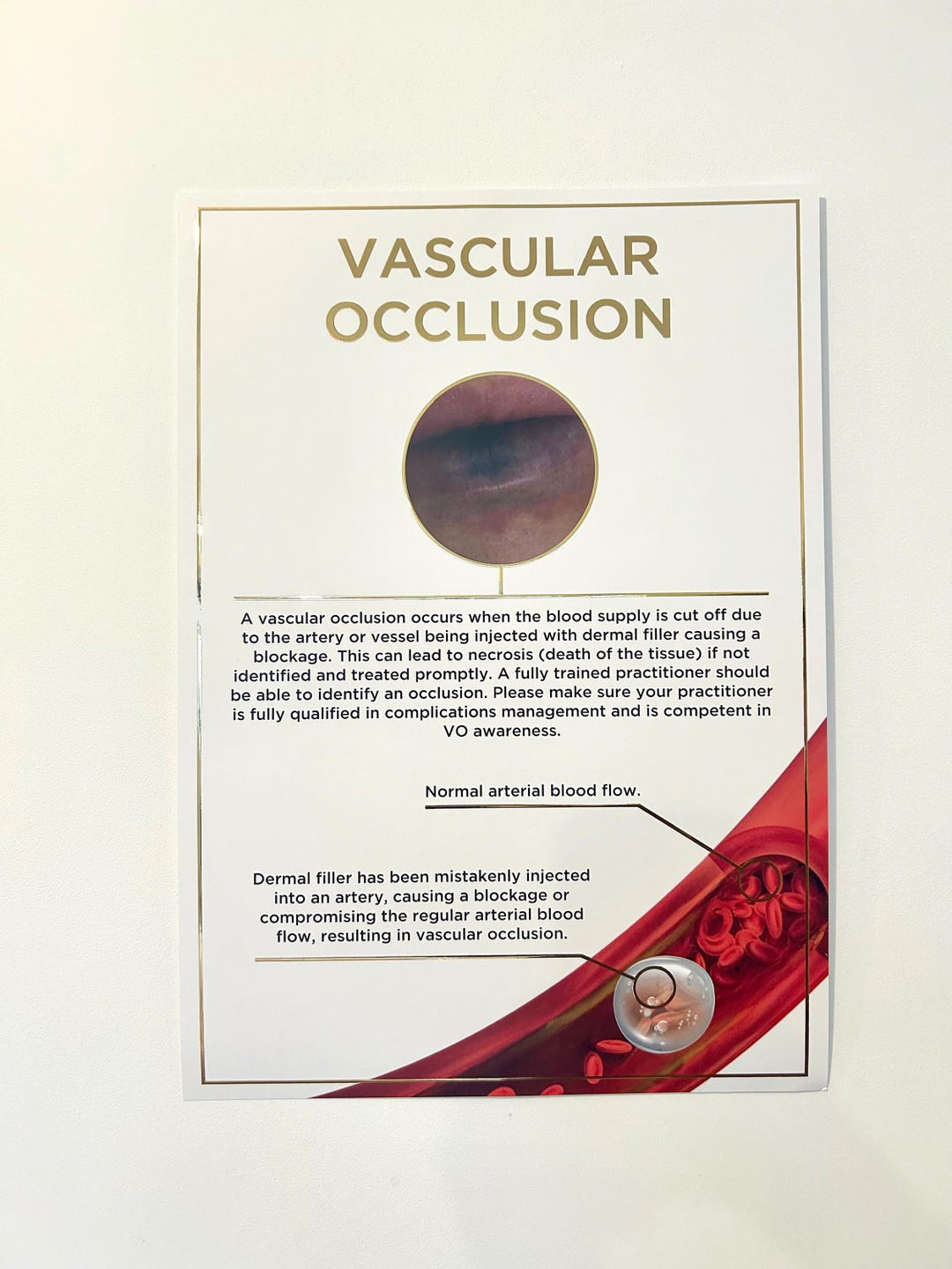 Raised Foiled Vascular Occlusion Poster - Etsy