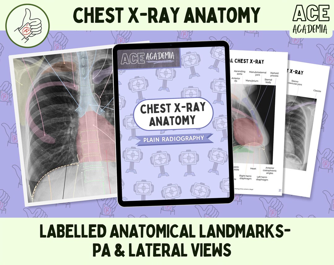 Chest X-ray Anatomy, PA and Lateral Views for Rad Techs, Radiographers ...