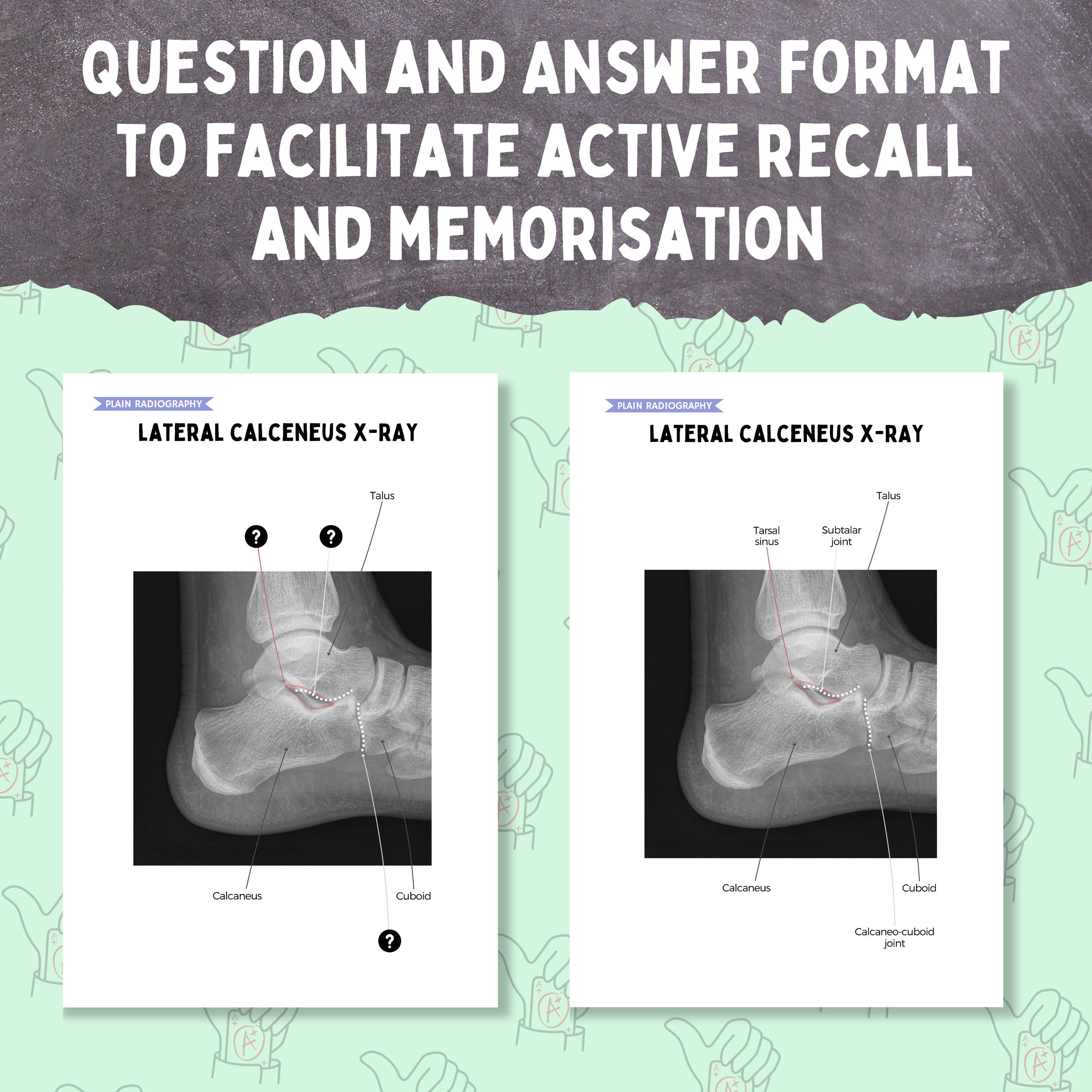 2026 Calcaneus X-ray Anatomy, Axial and Lateral Study Bundle for Rad ...