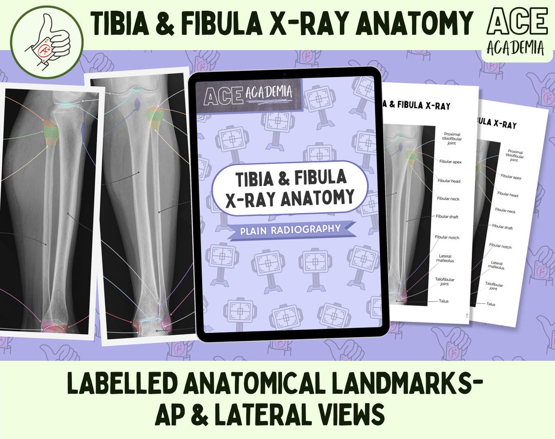 2025 Tibia & Fibula X-ray Anatomy, AP and Lateral Study Bundle for Rad ...