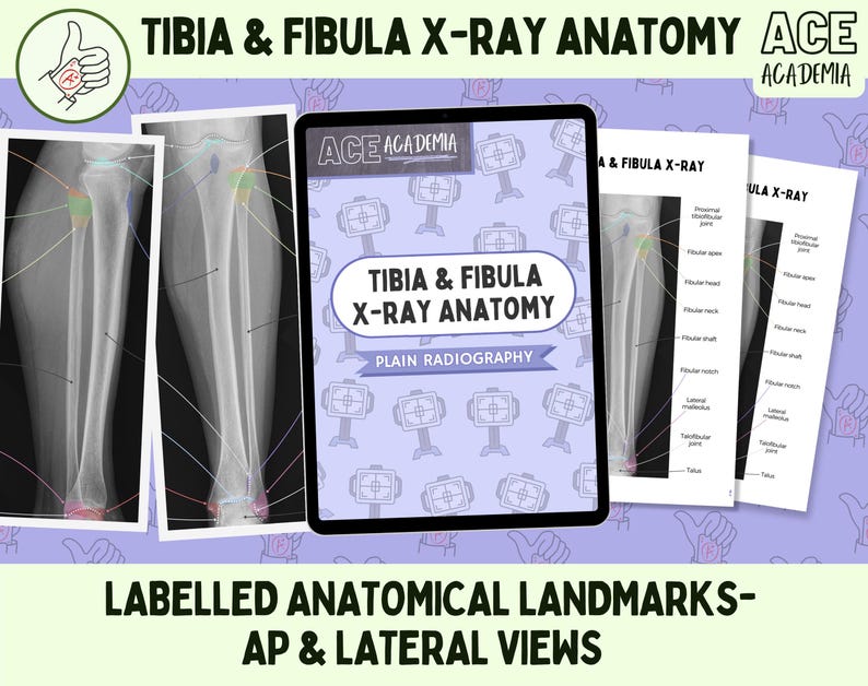 Buy 2025 Tibia & Fibula X-ray Anatomy, AP and Lateral Study Bundle for ...