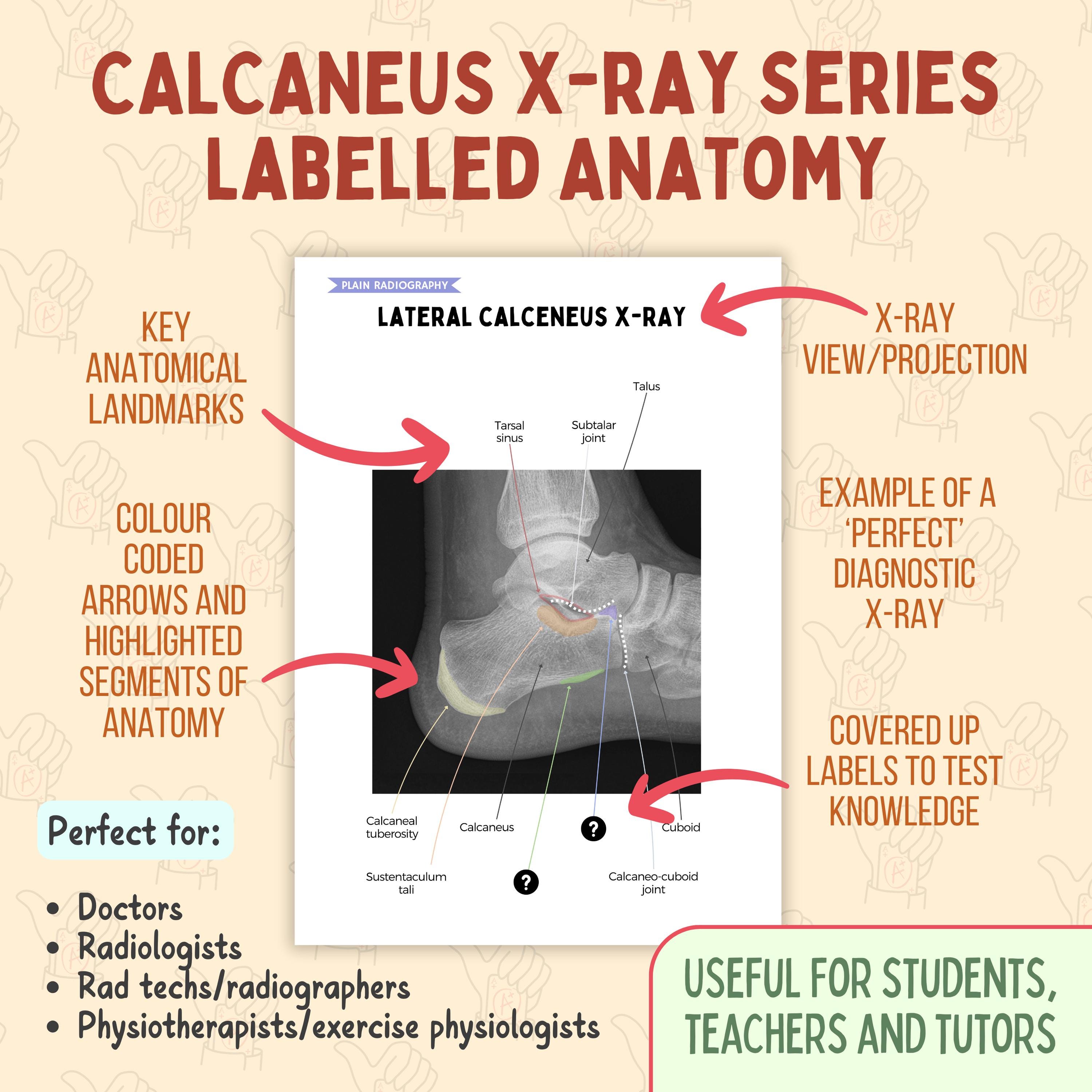 2025 Calcaneus X-ray Anatomy, Axial and Lateral Study Bundle for Rad ...