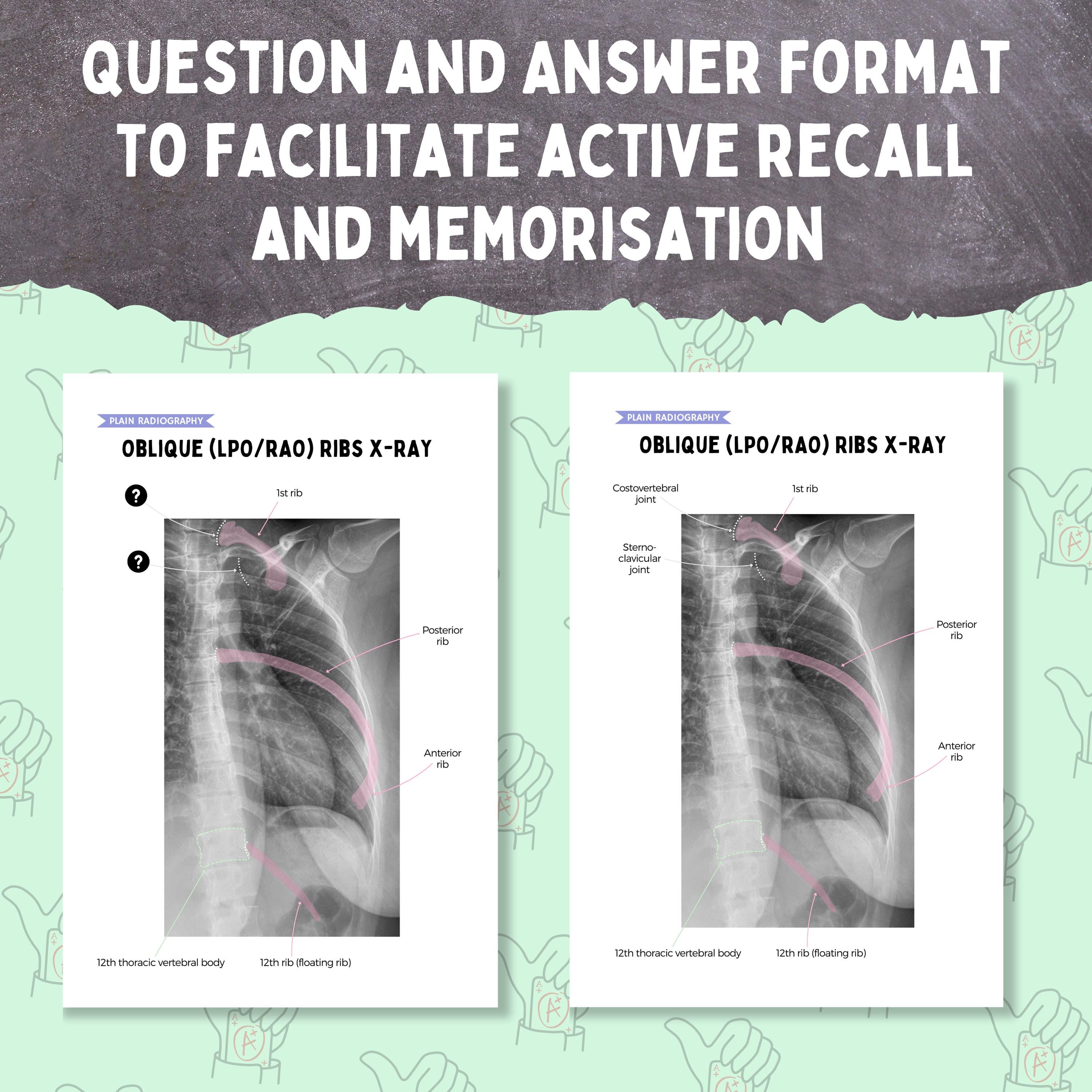 Rib X-ray Anatomy Study: Oblique Views, Labeled Landmarks (PDF) - Etsy