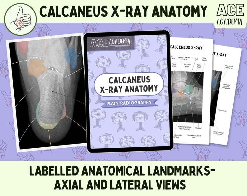 2025 Calcaneus X-ray Anatomy, Axial and Lateral Study Bundle for Rad ...