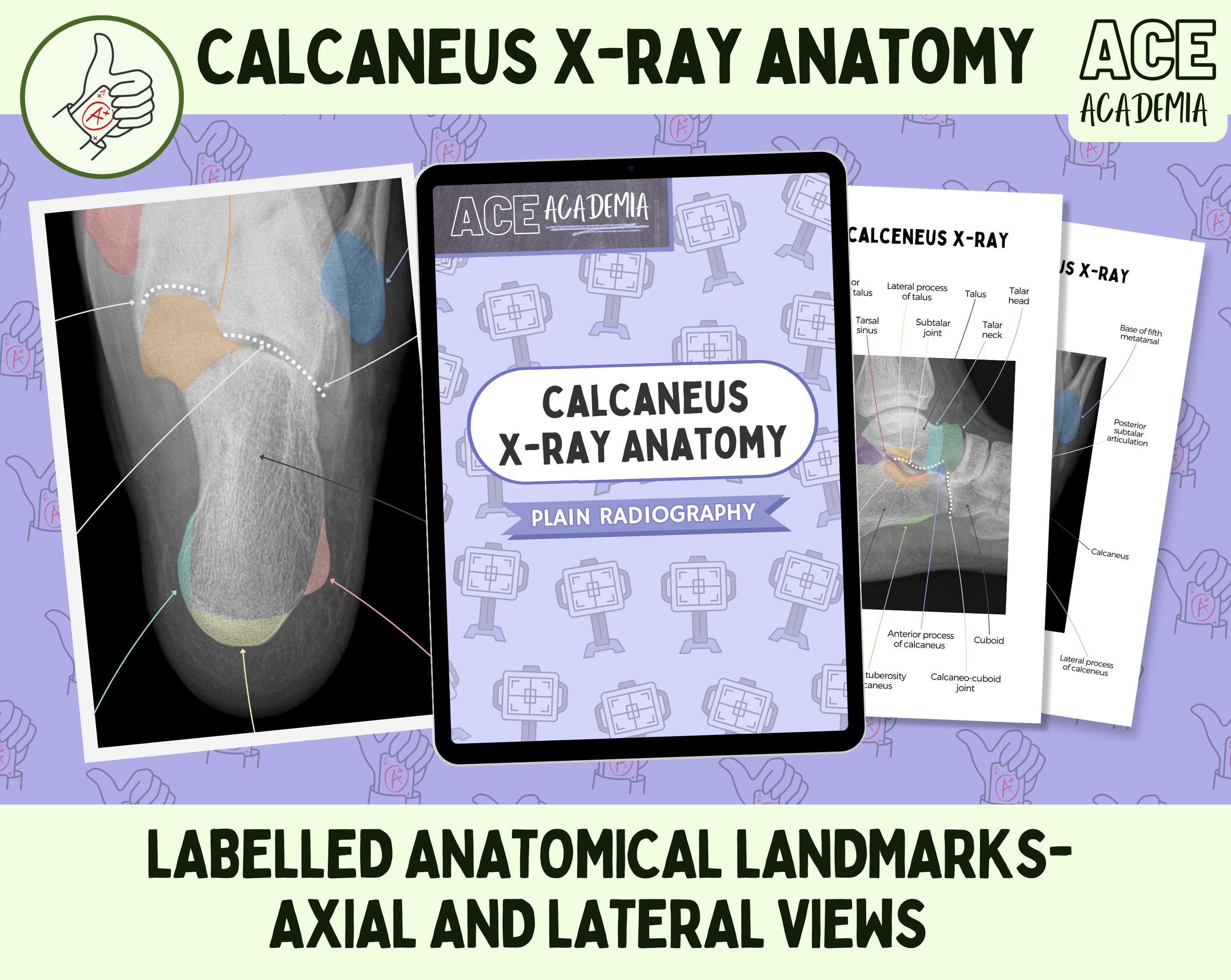2026 Calcaneus X-ray Anatomy, Axial and Lateral Study Bundle for Rad ...