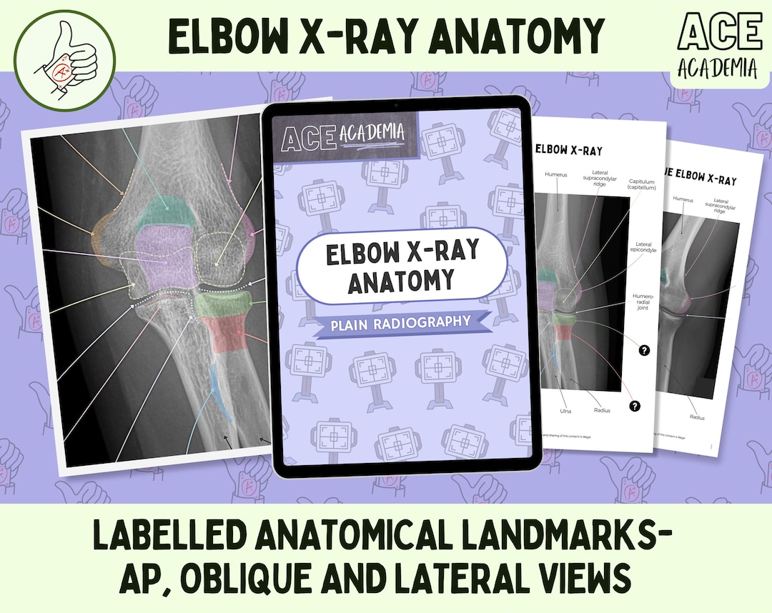 Elbow X-ray Anatomy, AP Oblique and Lateral Views for Rad Techs ...