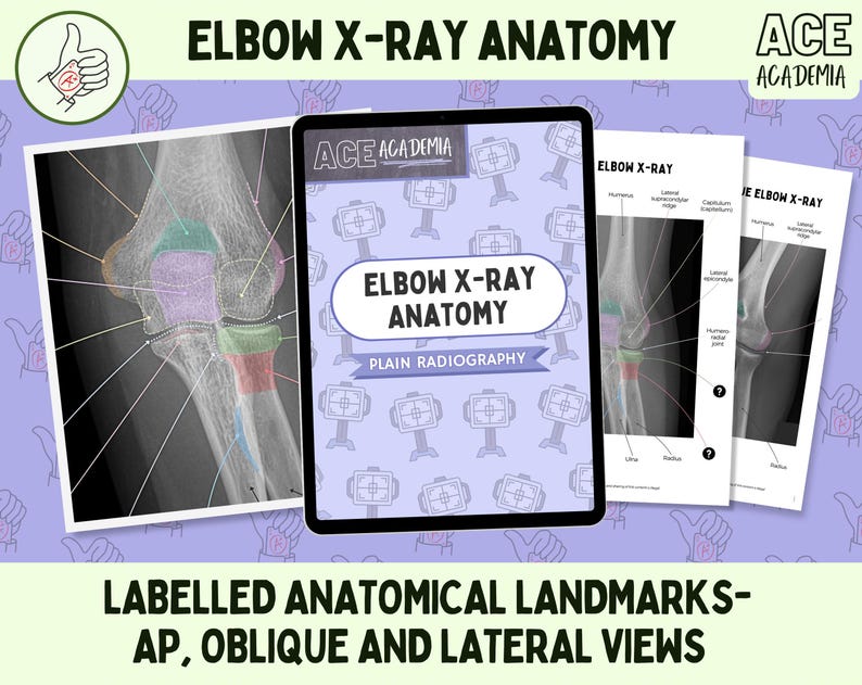 Elbow X-ray Anatomy, AP Oblique and Lateral Views for Rad Techs ...