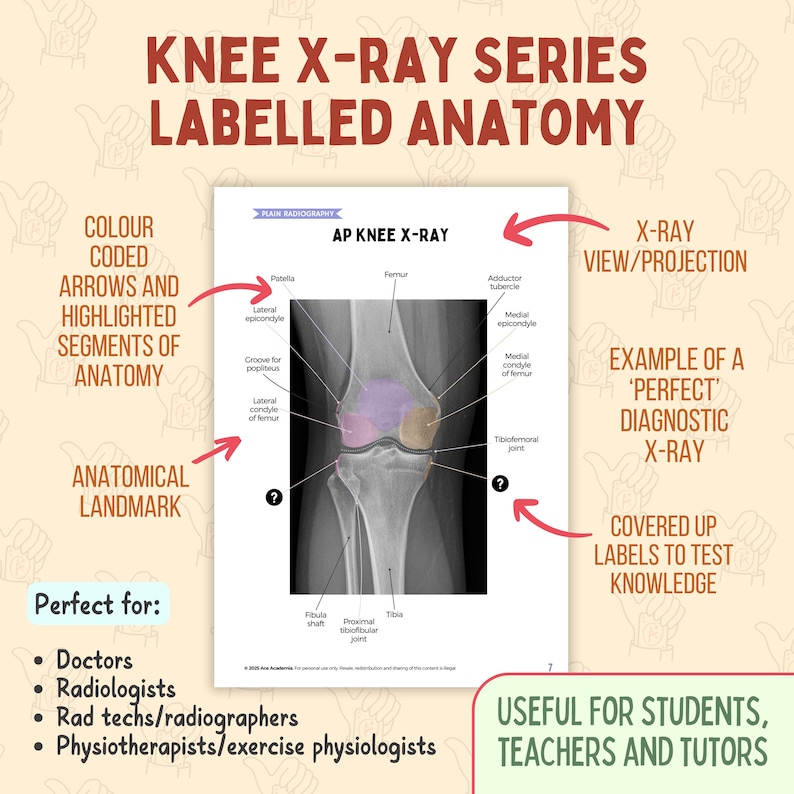 Knee X-ray Anatomy, AP Lateral Skyline and Rosenberg Views for Rad ...