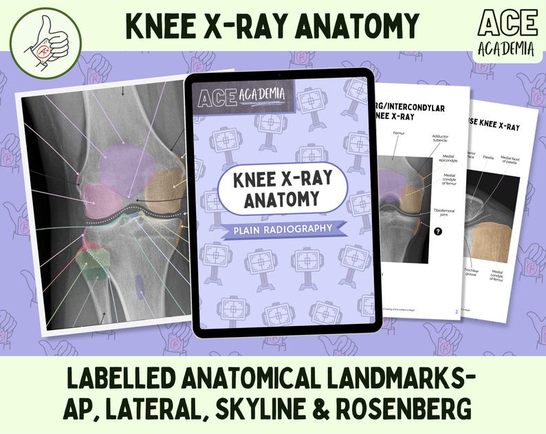 Knee X-ray Anatomy, AP Lateral Skyline and Rosenberg Views for Rad ...