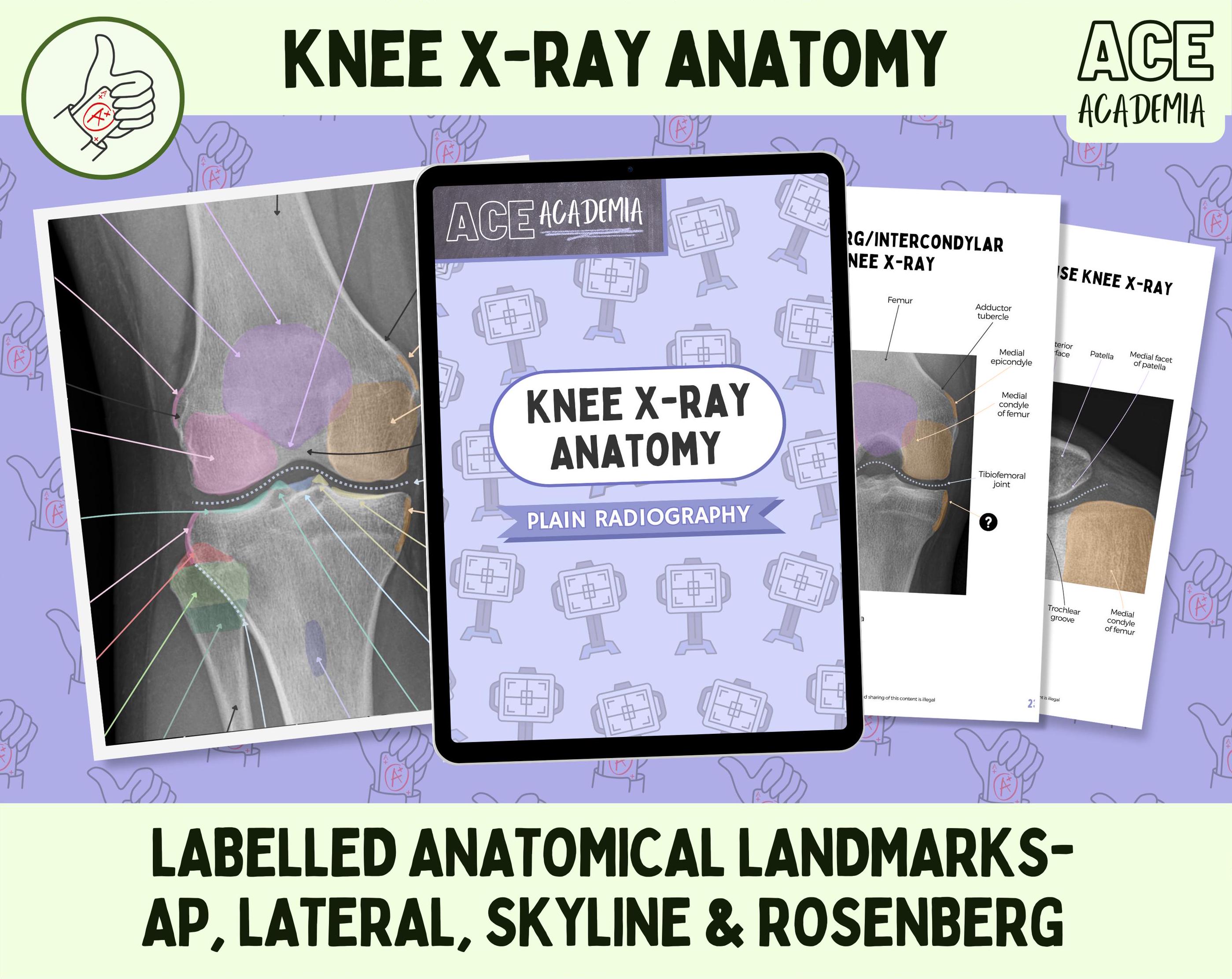 Knee X-ray Anatomy, AP Lateral Skyline and Rosenberg Views for Rad ...