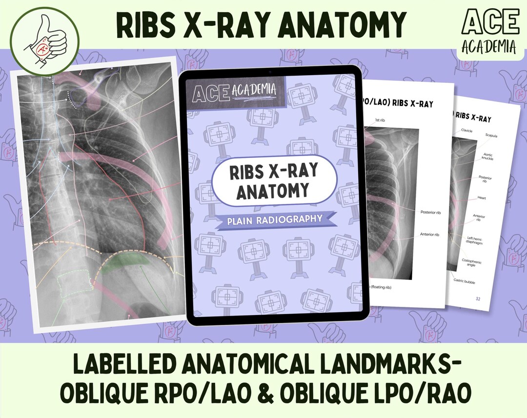 2025 Ribs X-ray Anatomy, Oblique RAO and LAO Views for Rad Techs ...