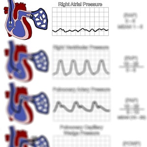 Pulmonary Artery Catheter (right Heart Pressures / Waveforms) Reference ...