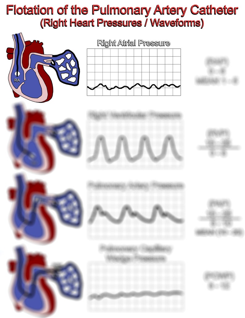 Pulmonary Artery Catheter (right Heart Pressures / Waveforms) Reference ...