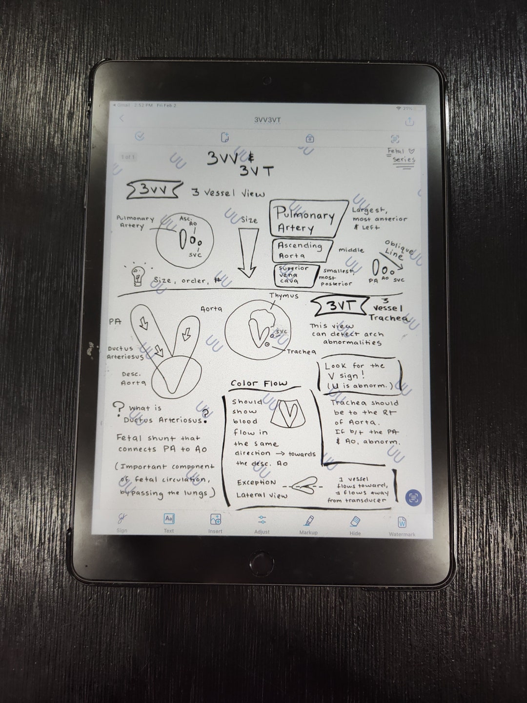 Fetal Heart Ultrasound Visual Reference: 3VV & 3VT (black and White) - Etsy