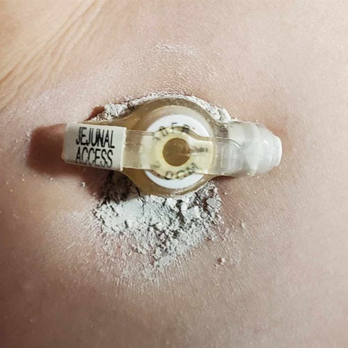 Stomaease™ Powder, Leakage, Odor Relief for Enteral Stomas g-tubes & J ...