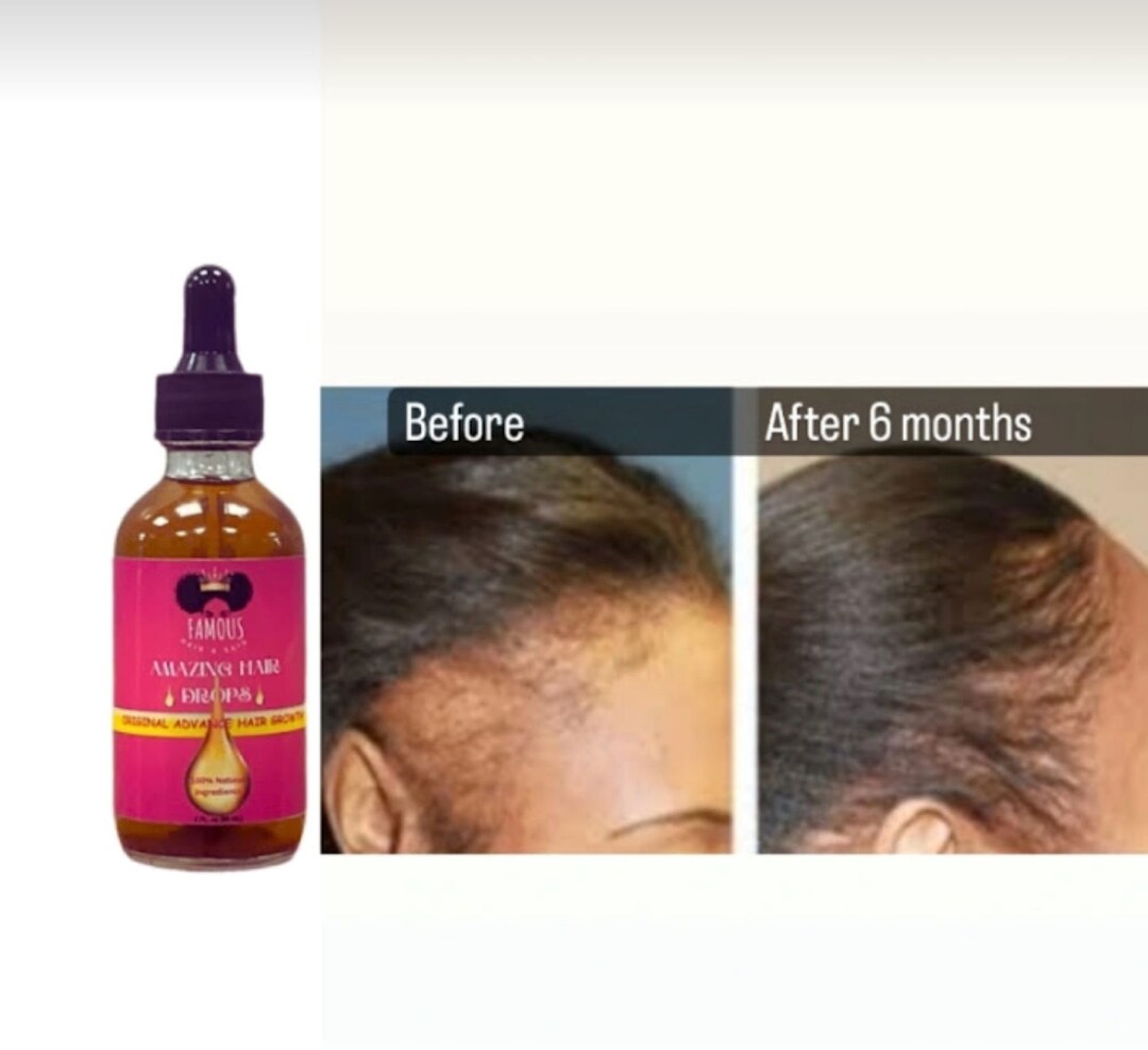 2 Oz AMAZING HAIR DROPS/ Hair Drops for Balding/hair Serum for Dry Hair ...