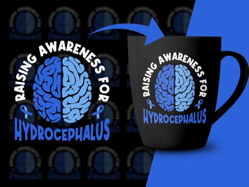 Hydrocephalus Awareness Svg Png: Blue Ribbon Design (digital Download ...