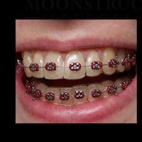 Fake Braces - Etsy