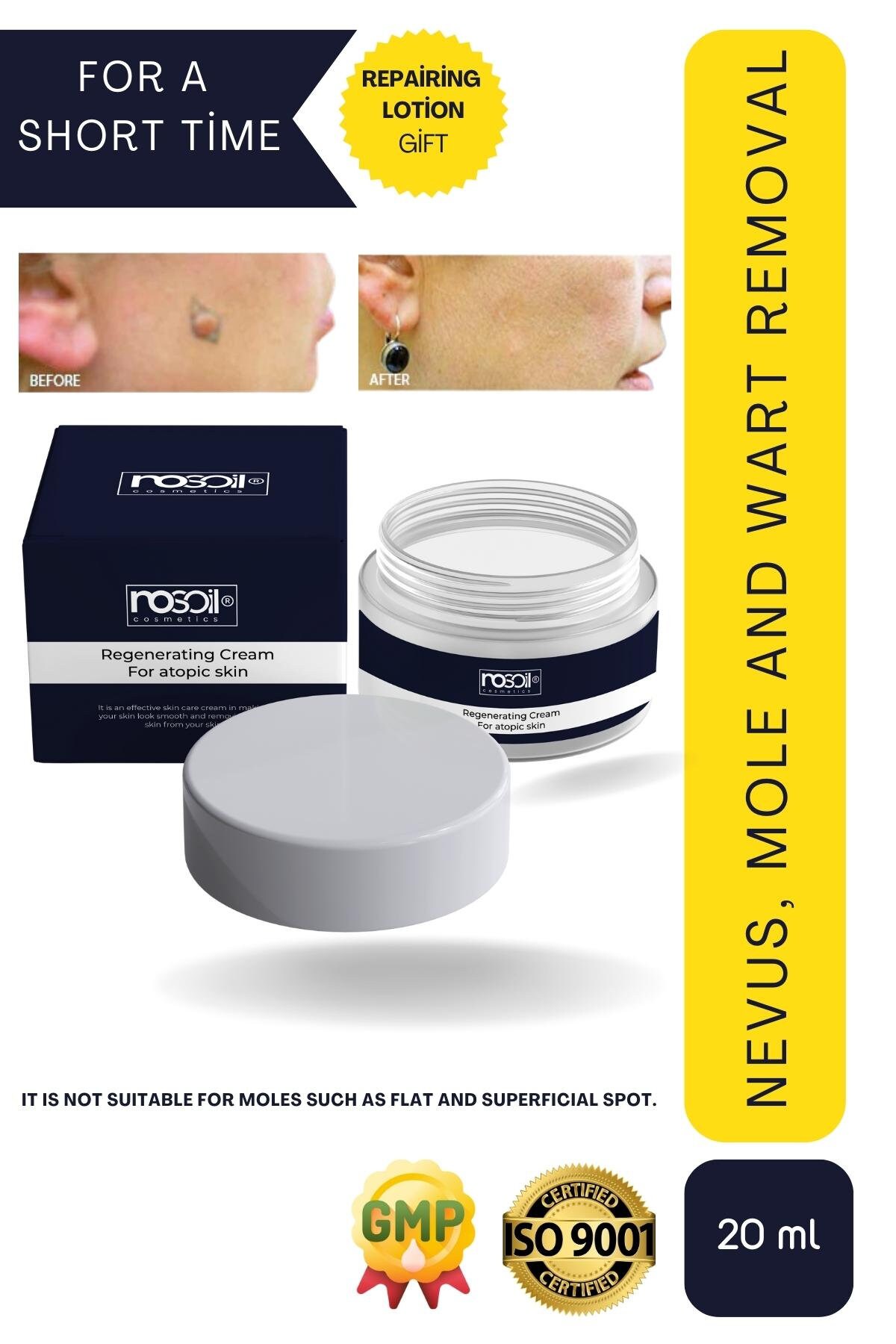 Skin Moles Removal Cream