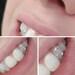 Great Fitting Retainer With Diamonds Customization or Logo.1 Top or ...