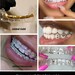 Customize Your Own Unique Retainer With a Perfect Fit & With Your ...